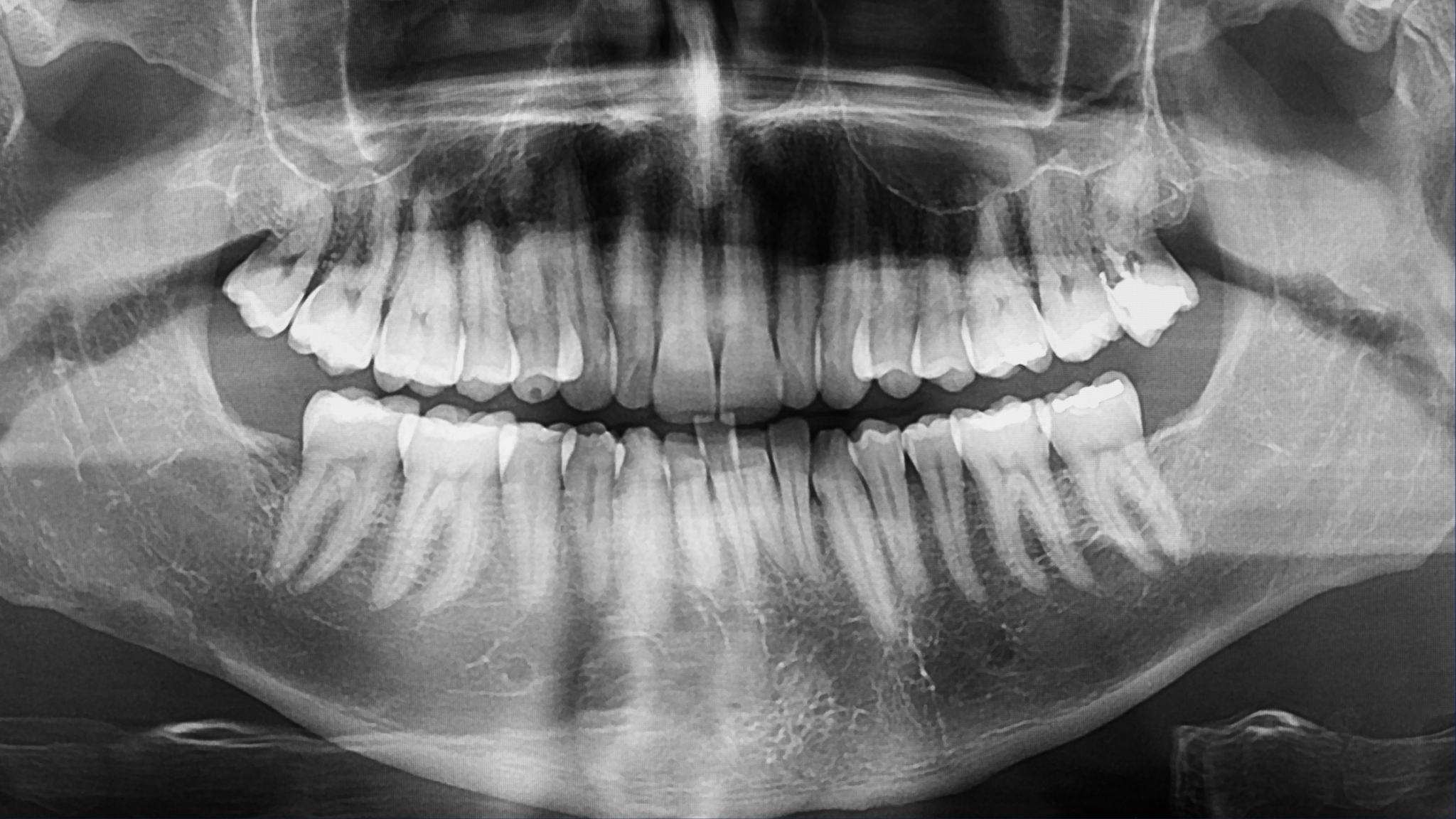 Raio-X Odontológico Panorâmico ou Periapical: Qual a Diferença e Quando ...